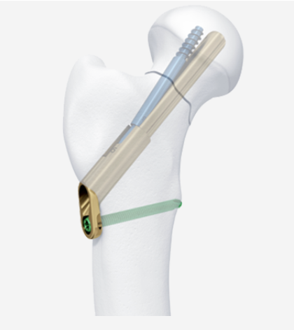 Fixation | The Bone School